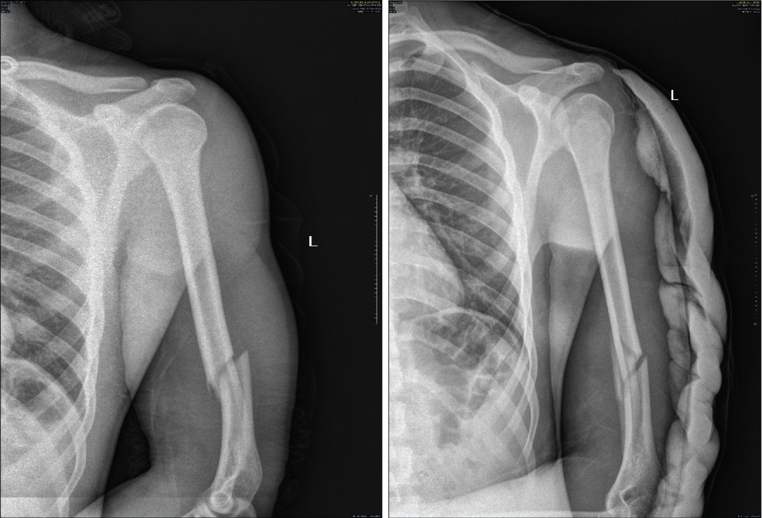 How to avoid arm breaks in Arm Wrestling – Arm Wrestling Store